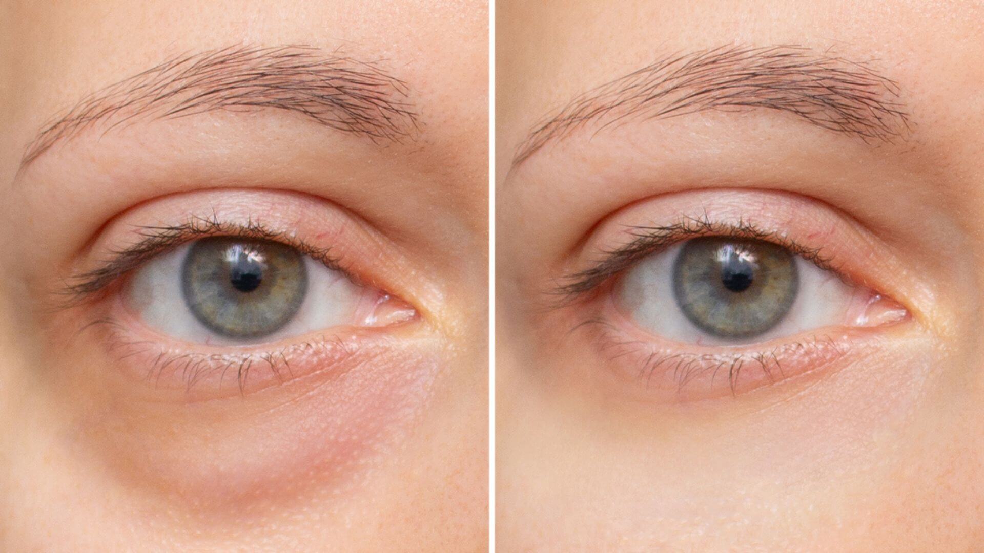 Blefaroplastia | Oftalmoclin